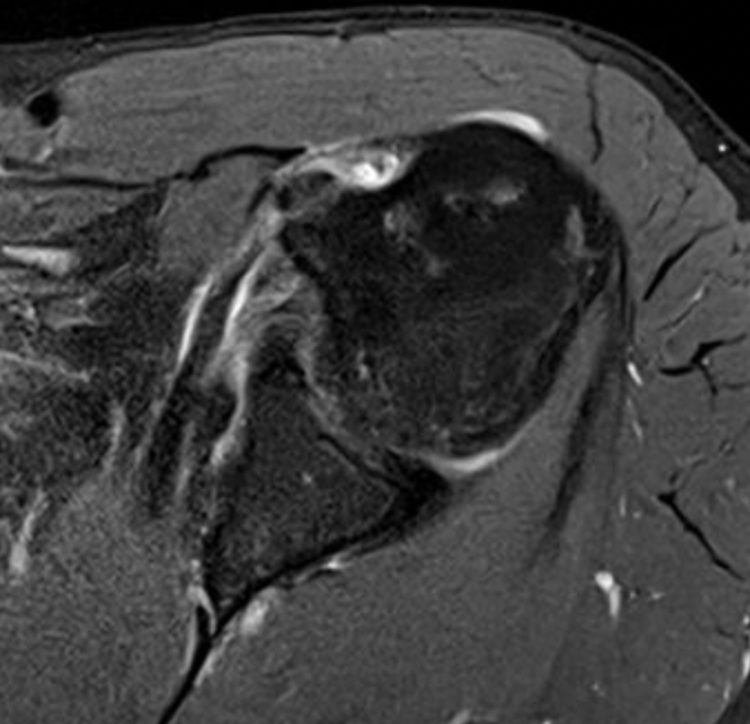 Medial subluxation of long head biceps | The Bone School